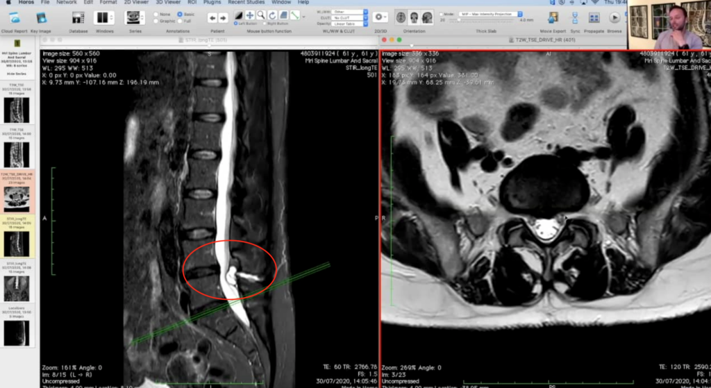 Module 6: Correlating MRI with Clinical Findings & Using MRI to Guide ...